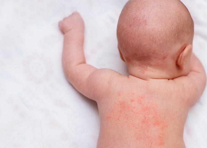 Common Baby Skin Rashes Causes Symptoms And Treatments Common Baby Skin Rashes Causes Symptoms And Treatments
