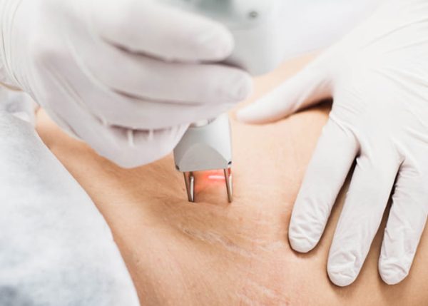 Stretch Marks: Myths vs. Facts and How to Manage Them