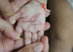 Scabies 101: What It Is, How It Spreads, and Treatment Tips